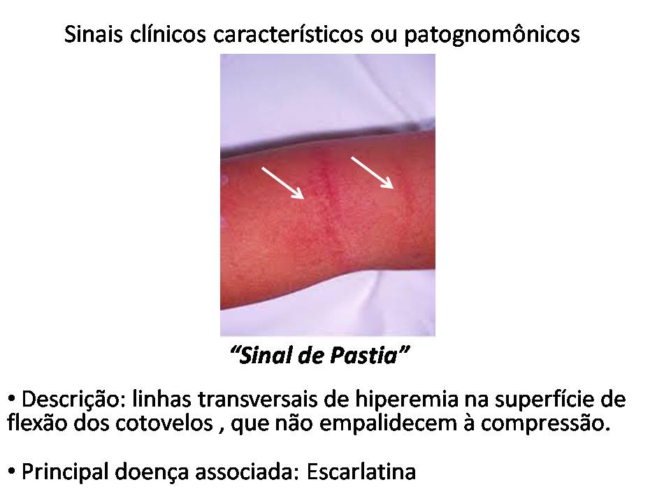 Sinal De Pastia E Filatov - BRAINCP