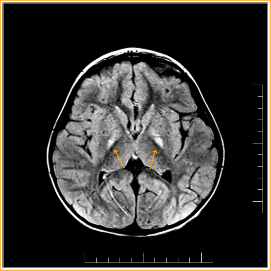 Chronic Kernicterus: MRI - Sumer's Radiology Blog