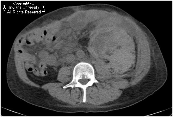 Flank pain: case presentation and MCQ