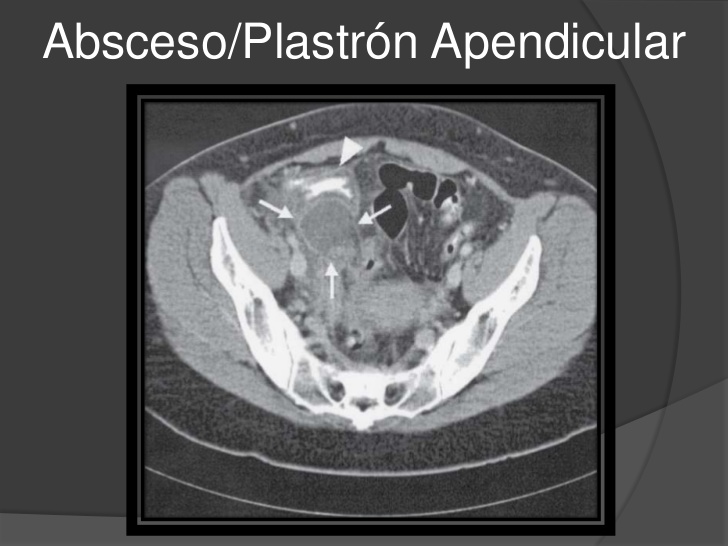 CONTROVERSIAS EN EL MANEJO DE PLASTRÓN APENDICULAR EN PACIENTES PEDIATRICOS