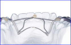 APARATOLOGIA ORTOPEDICA: FRANKEL IB
