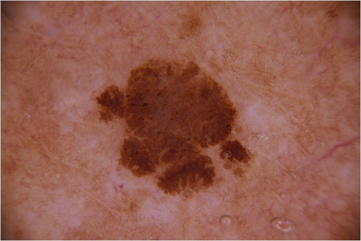 Dermatoscopia: Fingerprinting & Fat Fringers