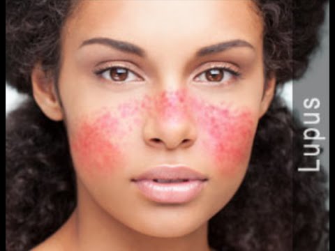General Information About Discoid Erythematosus Rash ~ ALL ABOUT LUPUS