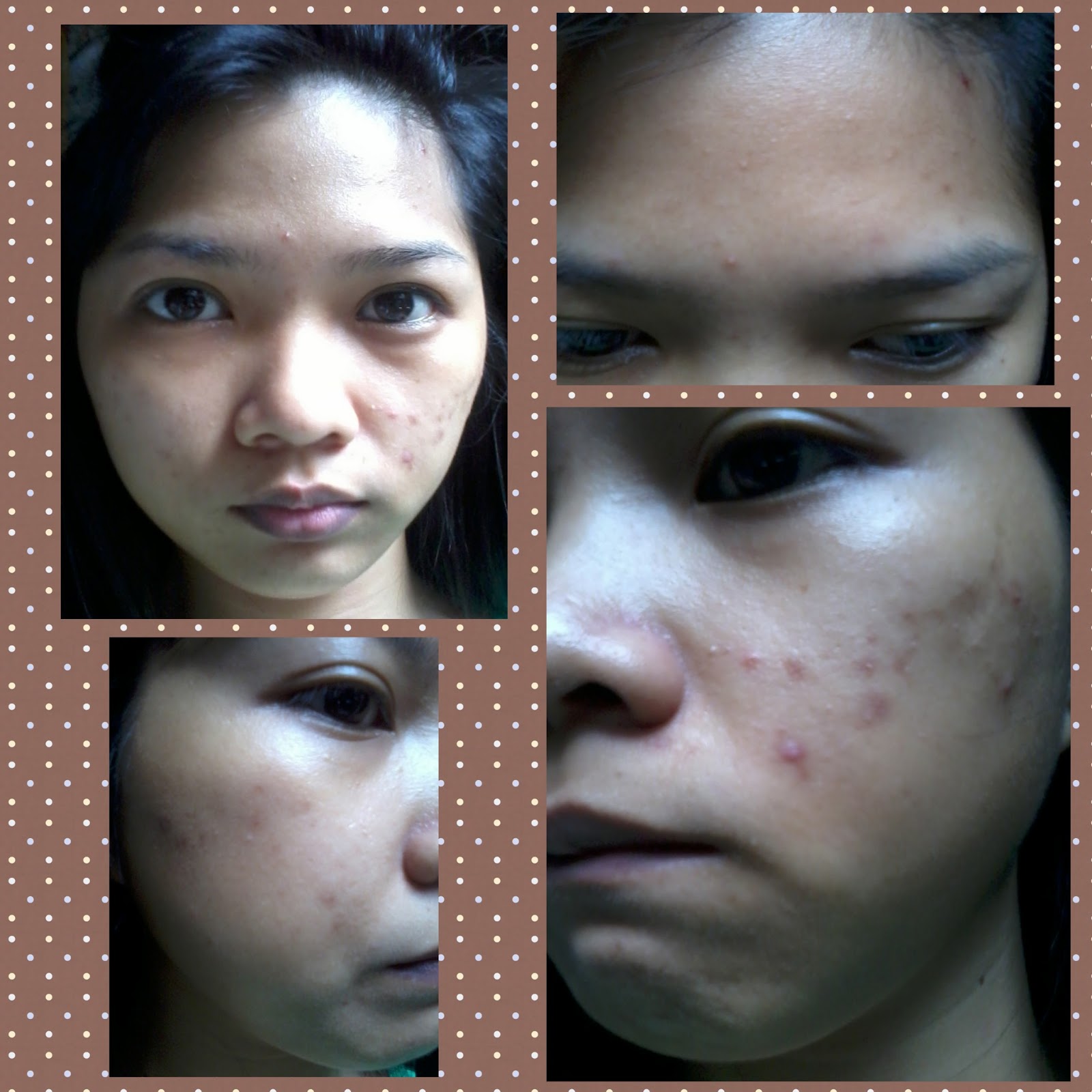 Angelamhiere's Little Heaven: Anti-Acne Team (My Skin Care Routine ...