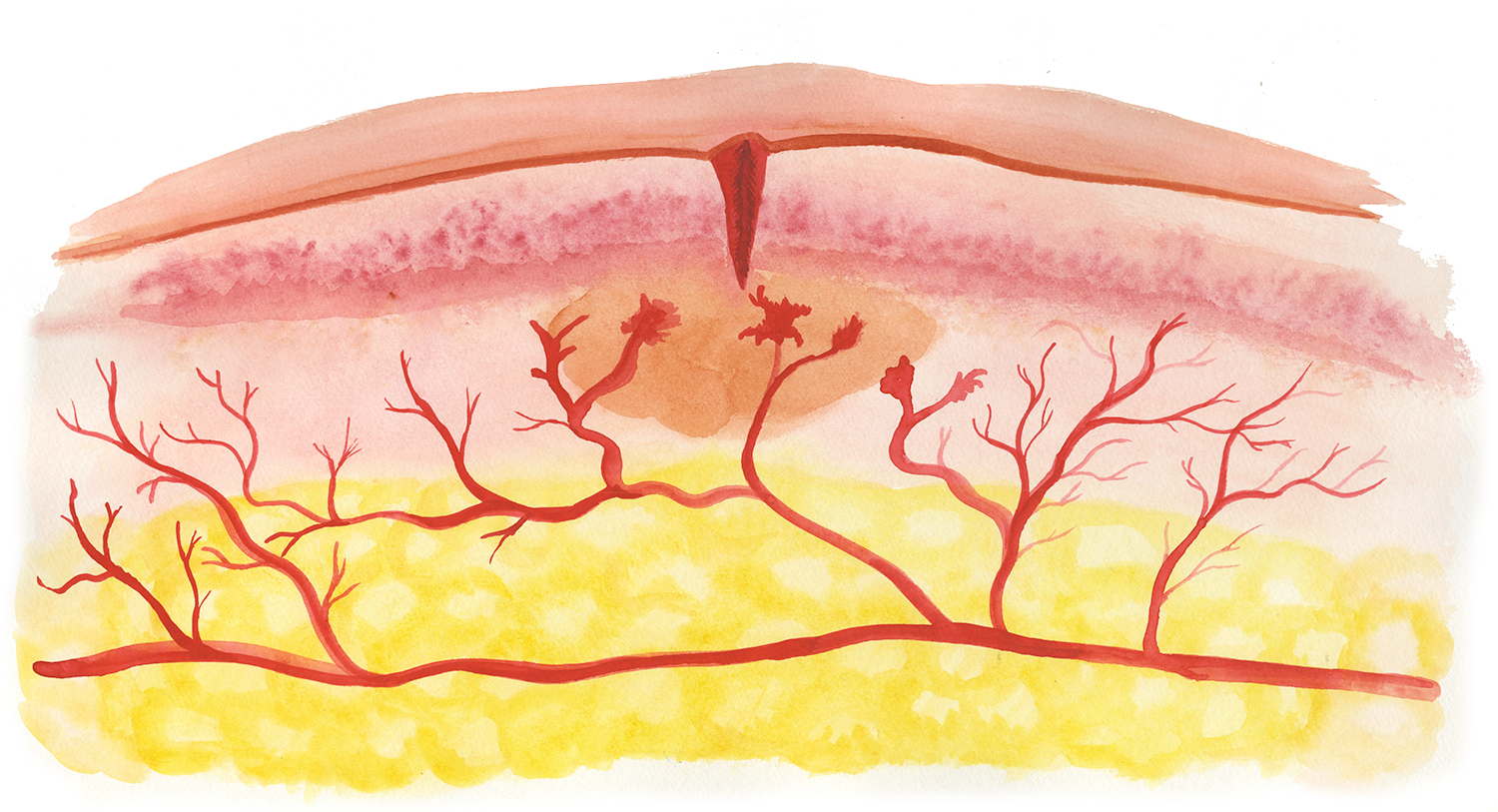 BRYAN JONES: Inflammation Illustration