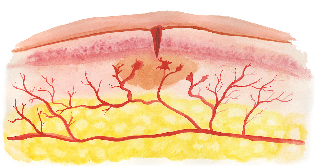 BRYAN JONES: Inflammation Illustration
