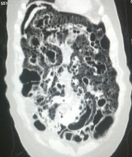 GastroenterologyOnline: Air bubbles everywhere in the abdomen