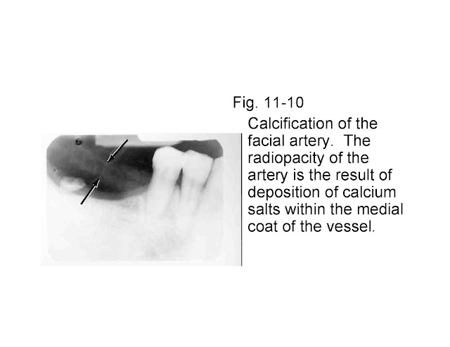 Dentistry and Medicine: SOFT TISSUE CALCIFICATIONS IN ORO-MAXILLO ...