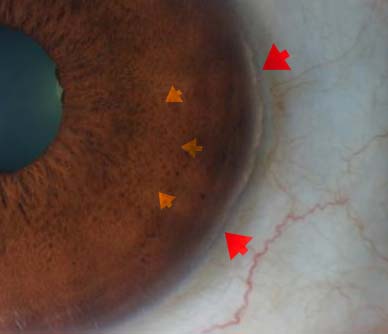 Modern & Multidimensional Iridology: Ferrum Chromatosis, Mammilations ...