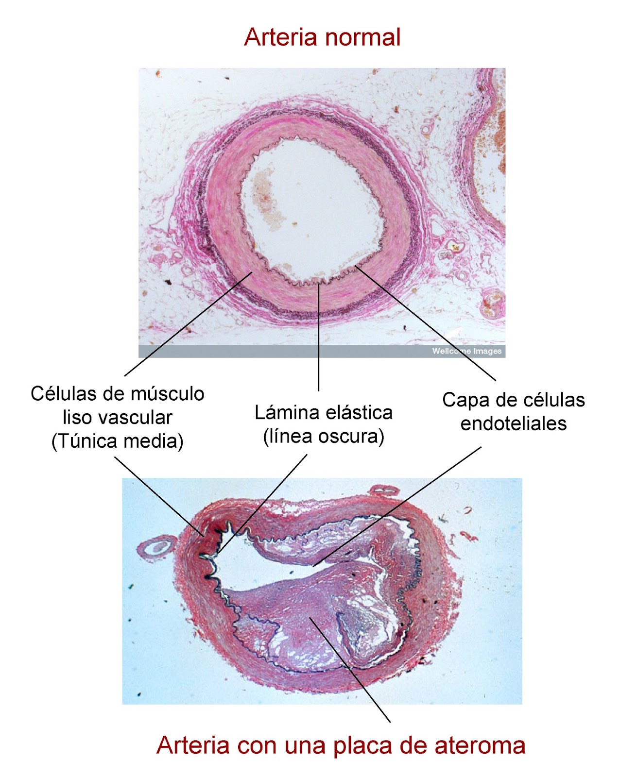 placa de ateroma - wood scribd braxin