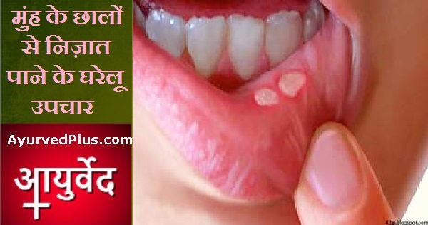 मुंह के छालों से निज़ात पाने के घरेलू उपचार आयुर्वेदप्लस