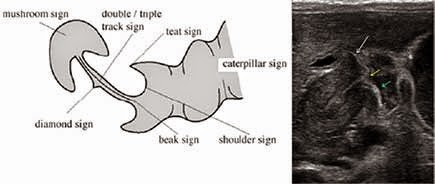 Pyloric Stenosis Shoulder Sign