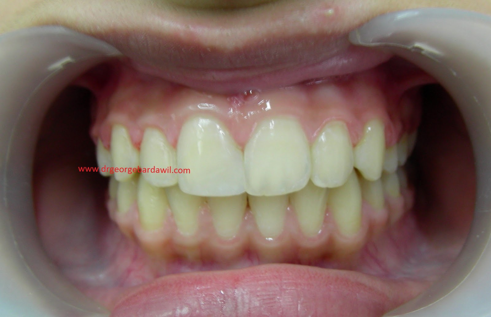 Dr.George E. Bardawil-Orthodontist-Invisalign Diamond level : Tuesday ...