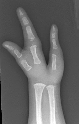 Ulnar Sided Cleft Hand | Congenital Hand and Arm Differences ...