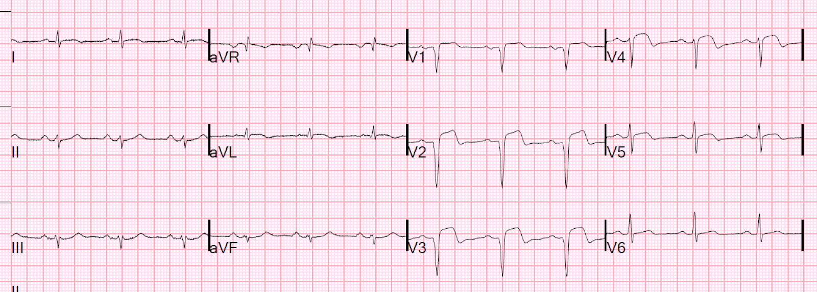 Borderline Ecg
