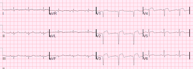 Dr. Smith's ECG Blog: Anterior STEMI and multiform PVCs with Narrow ...