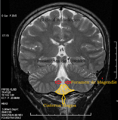 El Baúl Radiológico: ASPECTO DE LA CISTERNA MAGNA EN TOMOGRAFÍA ...