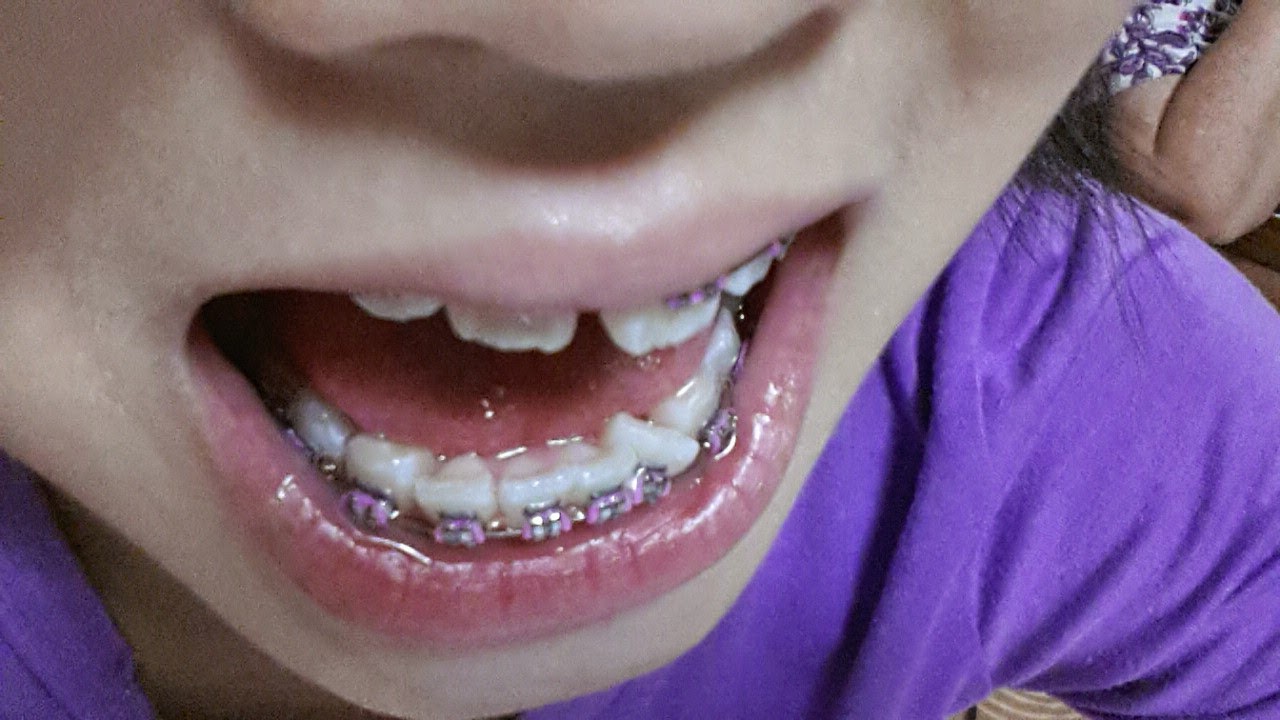 ♛Geraldine Yan♛: MY "BRACES" JOURNEY PART 1