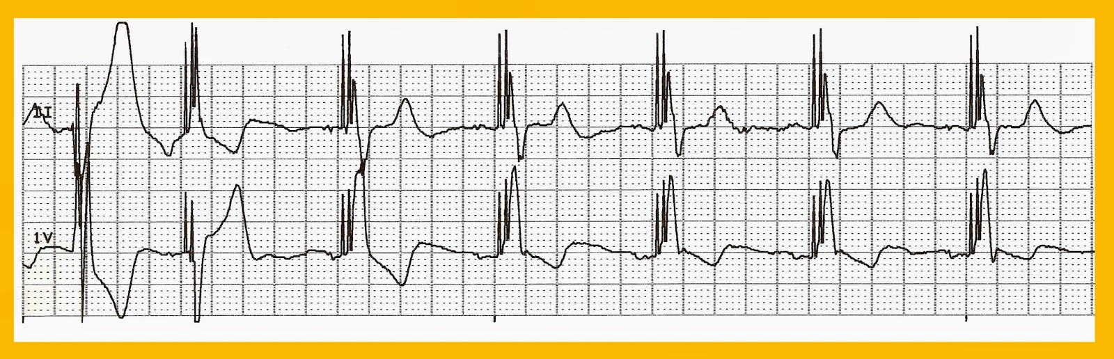 Practice Rhythm Strips 279