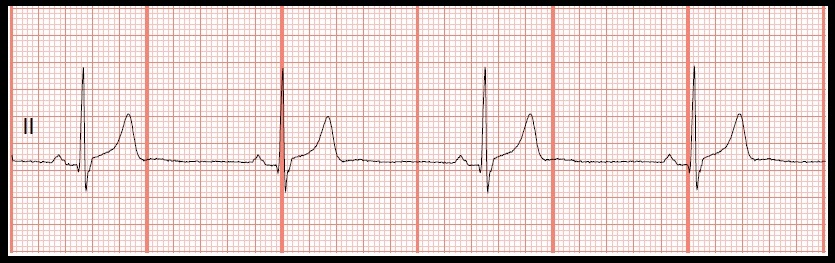 Characteristics of Sinus Rhythms