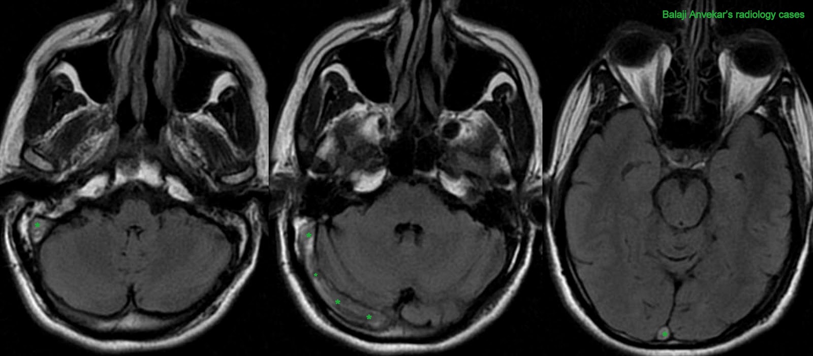 Dr Balaji Anvekar FRCR: Hyperdense dural venous sinuses on CT