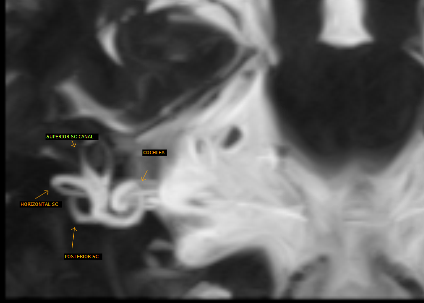 Membranous Labyrinth MRI - Sumer's Radiology Blog