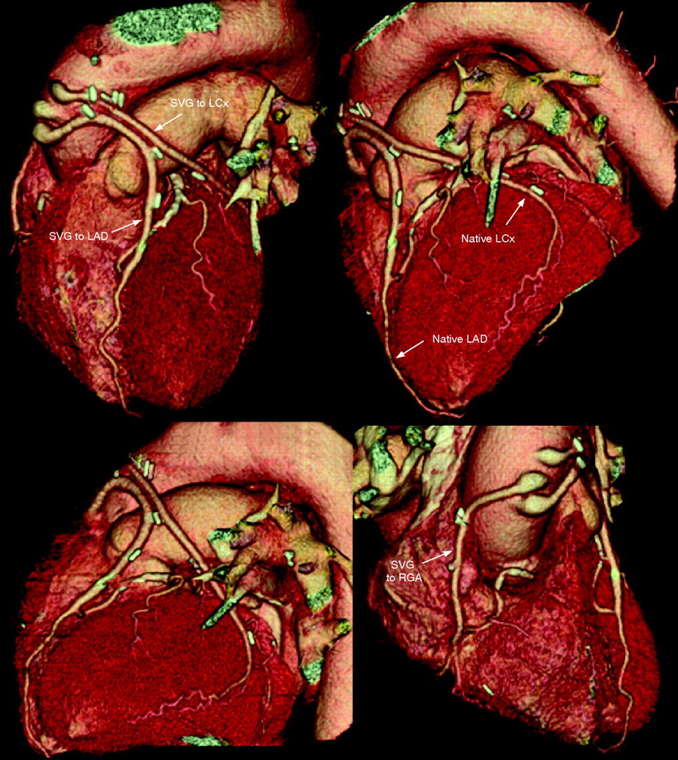 Instrumentasi Medis (Fisika): Multi Slice Computed Tomography ( MSCT )