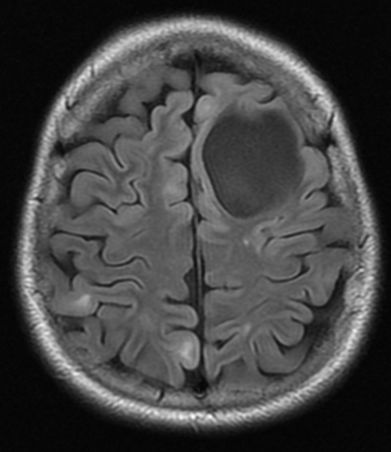 Radshare: TUBEROUS SCLEROSIS
