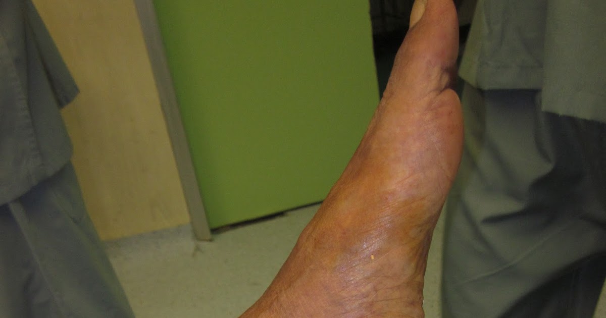 CRUSH INJURY FOOT, LOWER LIMB INJURIES AND LIMB SALVAGE: SKIN AVULSION ...