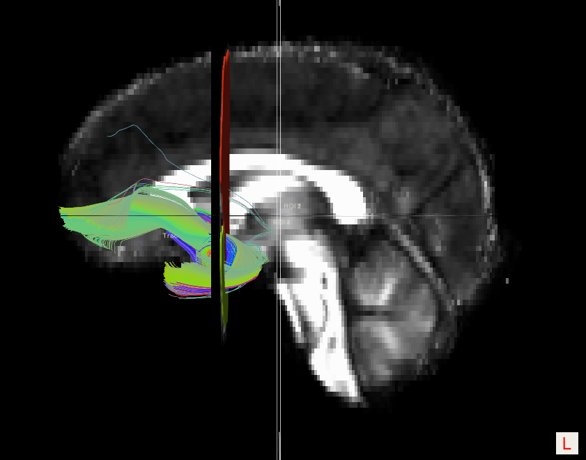 DTI Tutorial 3 - Fiber Tractography | Diffusion Imaging; Introduction ...