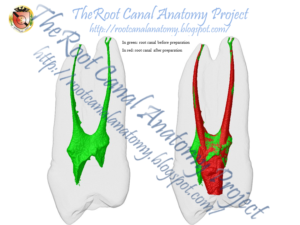 The Root Canal Anatomy Project: Conservative Endodontic Access ...