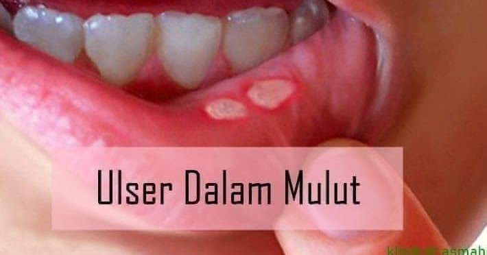 ULSER MULUT : PUNCA DAN CARA MERAWAT