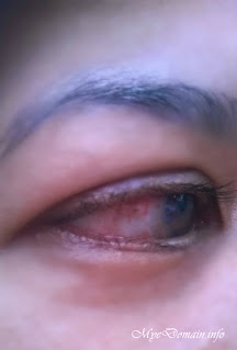 What Is Subconjunctival Hemorrhage? | Simplymarrimye