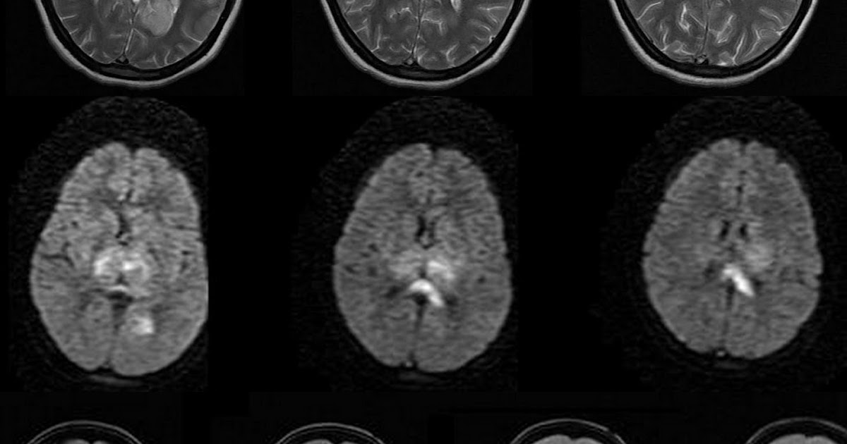 Neuroradiology Cases: Deep Cerebral Venous Thrombosis MRI