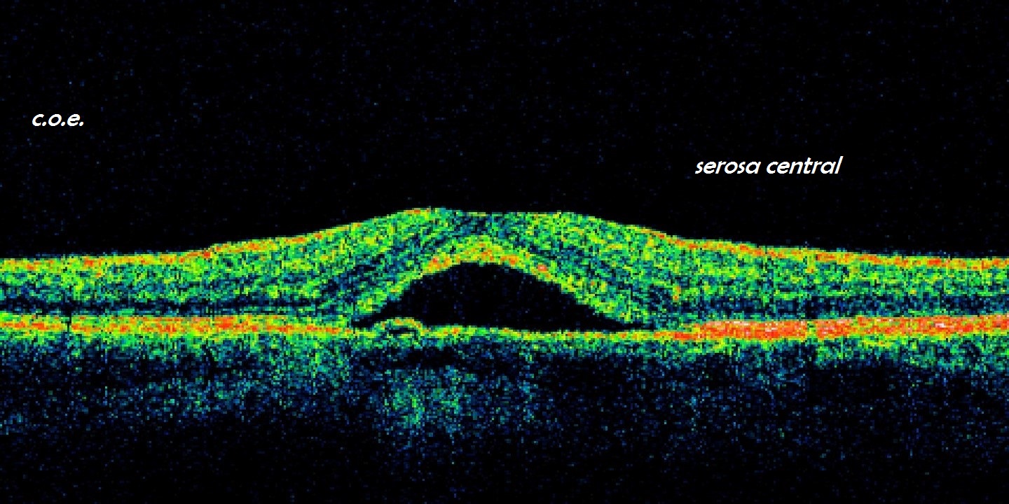 DEGENERACION MACULAR : OCT RETINA XI