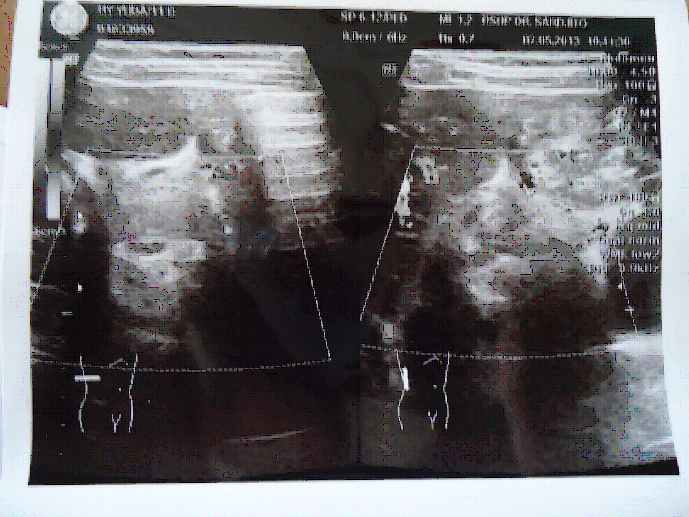 Kasus Intususepsi pada anak dengan milking procedure – Bedah Anak FK UGM