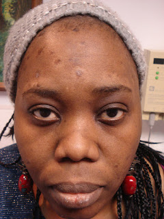 VIRTUAL GRAND ROUNDS IN DERMATOLOGY 2.0: Excoriated Acne with ...