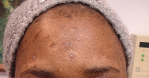 VIRTUAL GRAND ROUNDS IN DERMATOLOGY 2.0: Excoriated Acne with ...