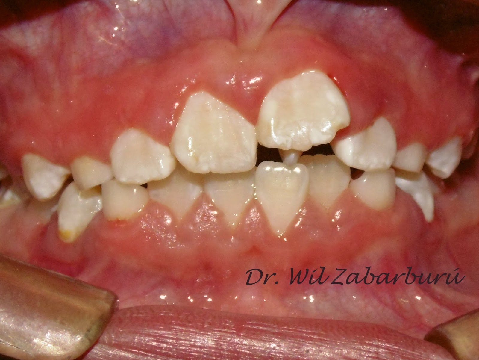 CLINICA DENTAL ASISTENCIAL: TALÓN CUSPÍDEO