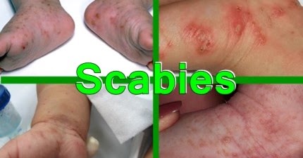 solusi herbal penyakit gatal kurap: Salep Untuk Obati Scabies Di Kulit ...