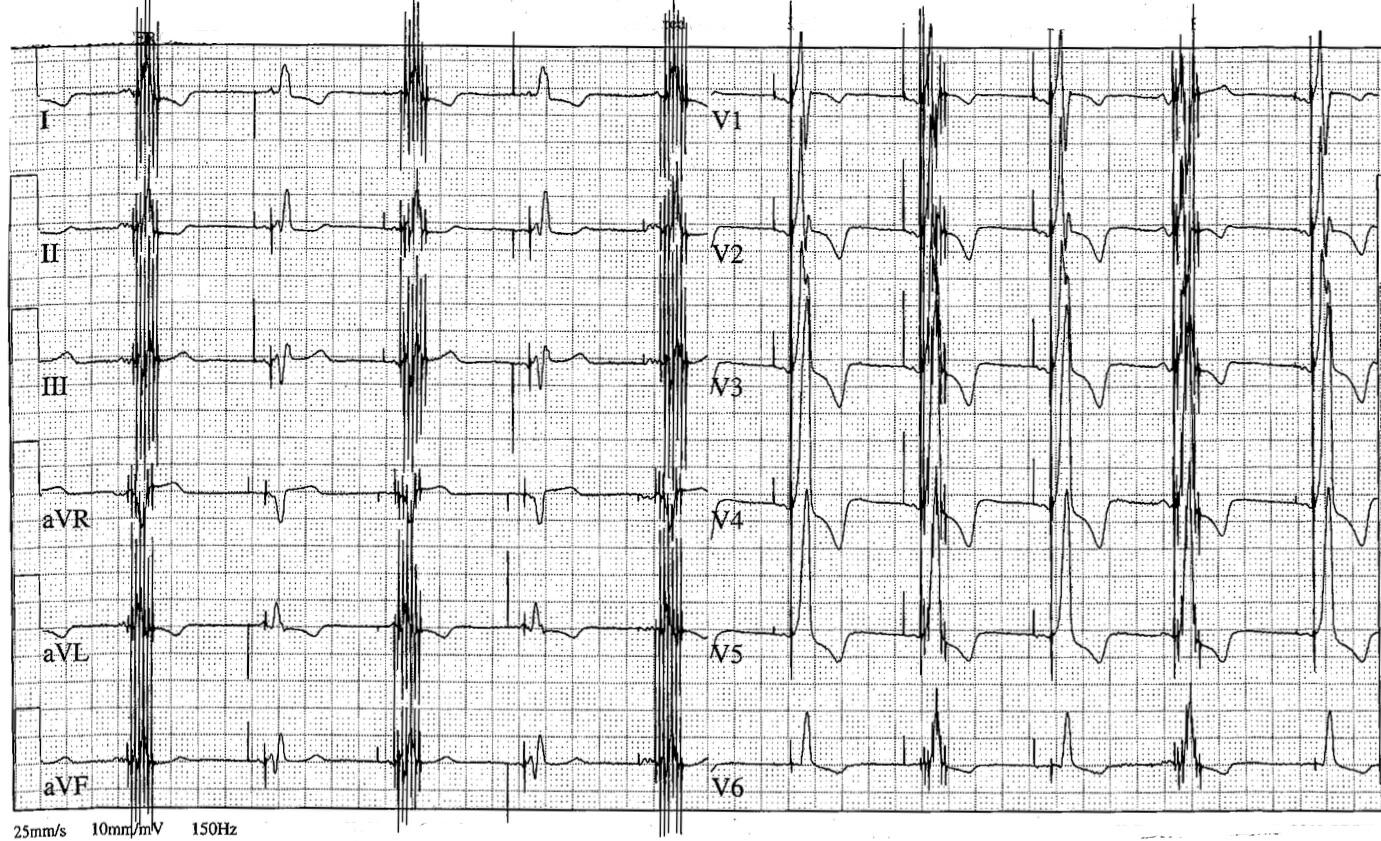 ECG of the Week: ECG of the Week - 9th September 2013 - Interpretation