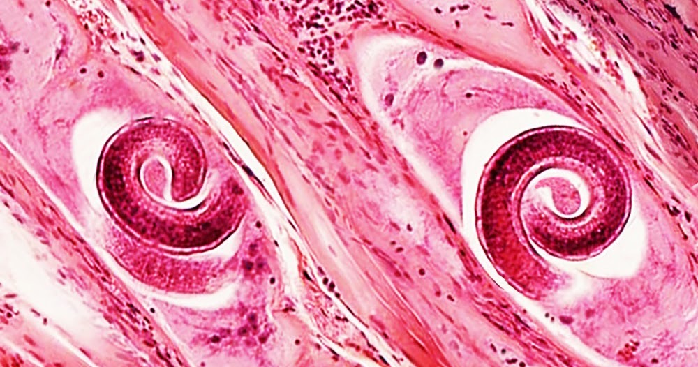 CURIOSIDADES CIENTÍFICAS : Triquinosis