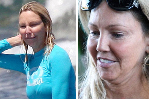 Heather Locklear Plastic Surgery