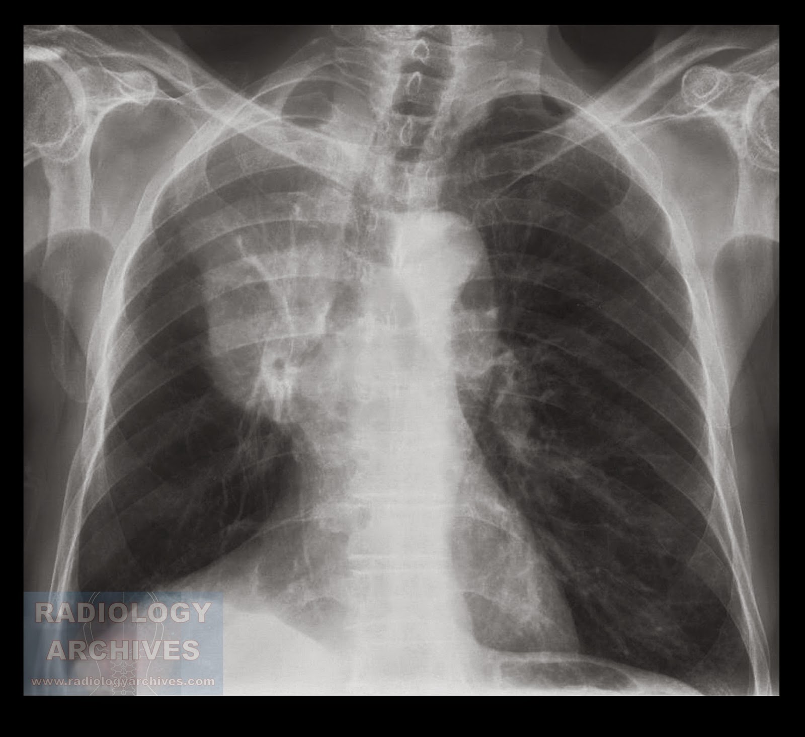 Radiology Archives: Golden* S Sign (Πυλαία Μάζα & Ατελεκτασία ΔΑΛ)