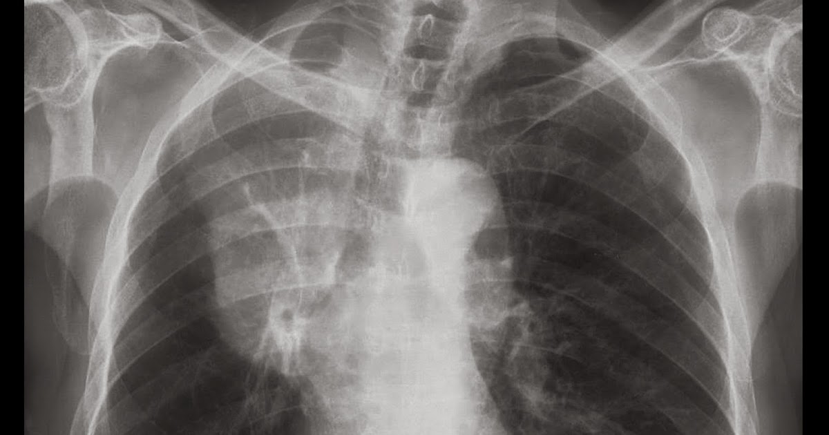 Radiology Archives: Golden* S Sign (Πυλαία Μάζα & Ατελεκτασία ΔΑΛ)