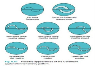PEMERIKSAAN TEKANAN INTRAOKULAR PADA PENDERITA MYOPI | HIMA PSPD ...