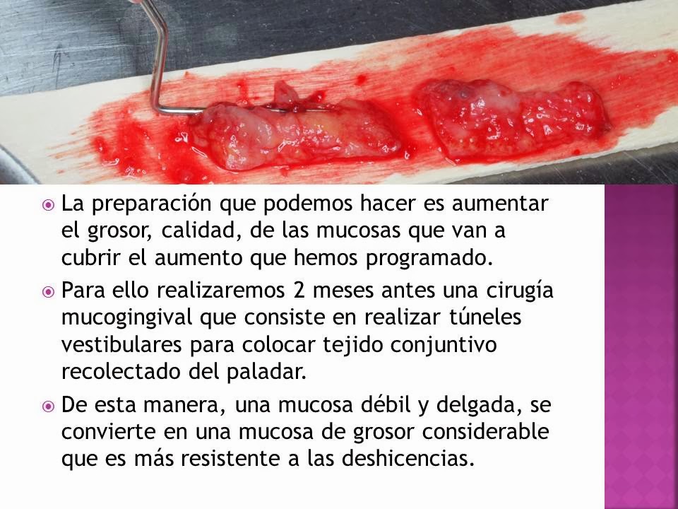 Escuela Implantológica Campos Clinicae: Injerto en Bloque Autólogo