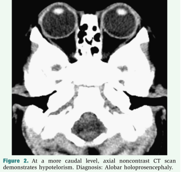 Lobar Holoprosencephaly-Mayo Radiology