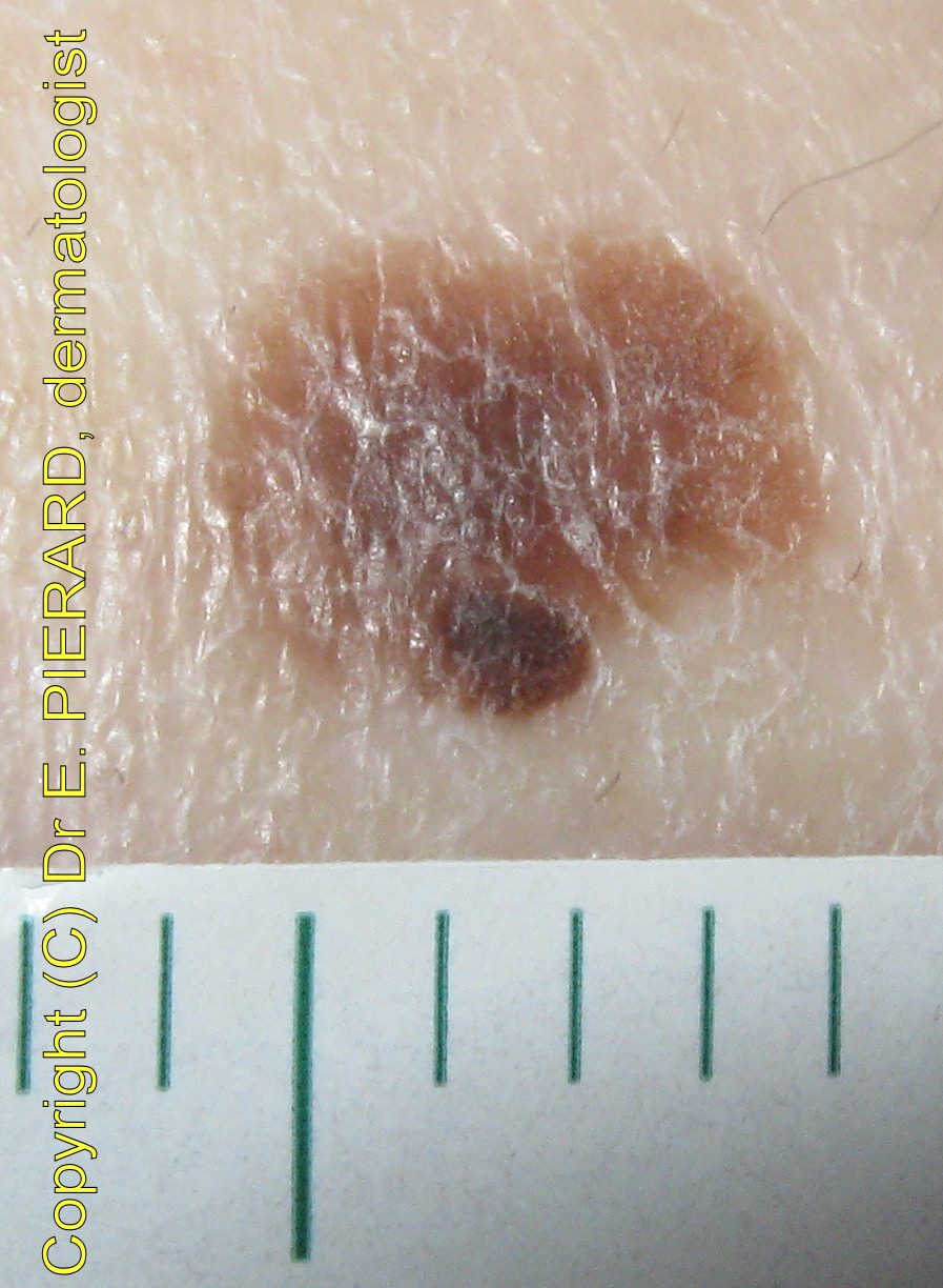 dermoscopy: Mole with an eccentric pigmentation