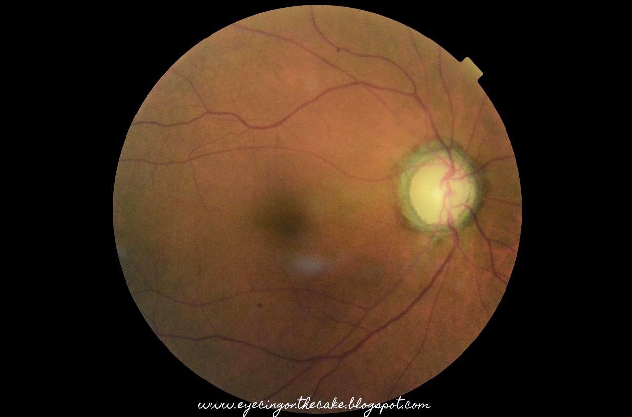 eyecing on the cake: Glaucoma Awareness Month